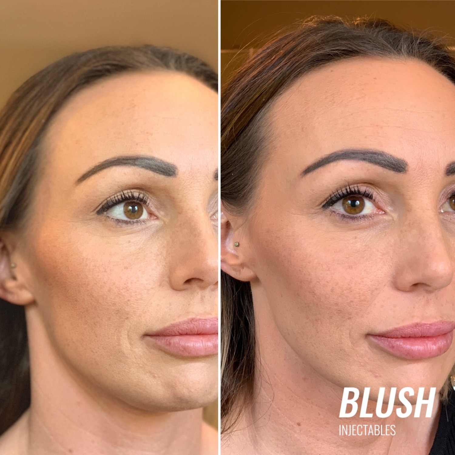 List 99+ Pictures Temple Filler Before And After Pictures Stunning