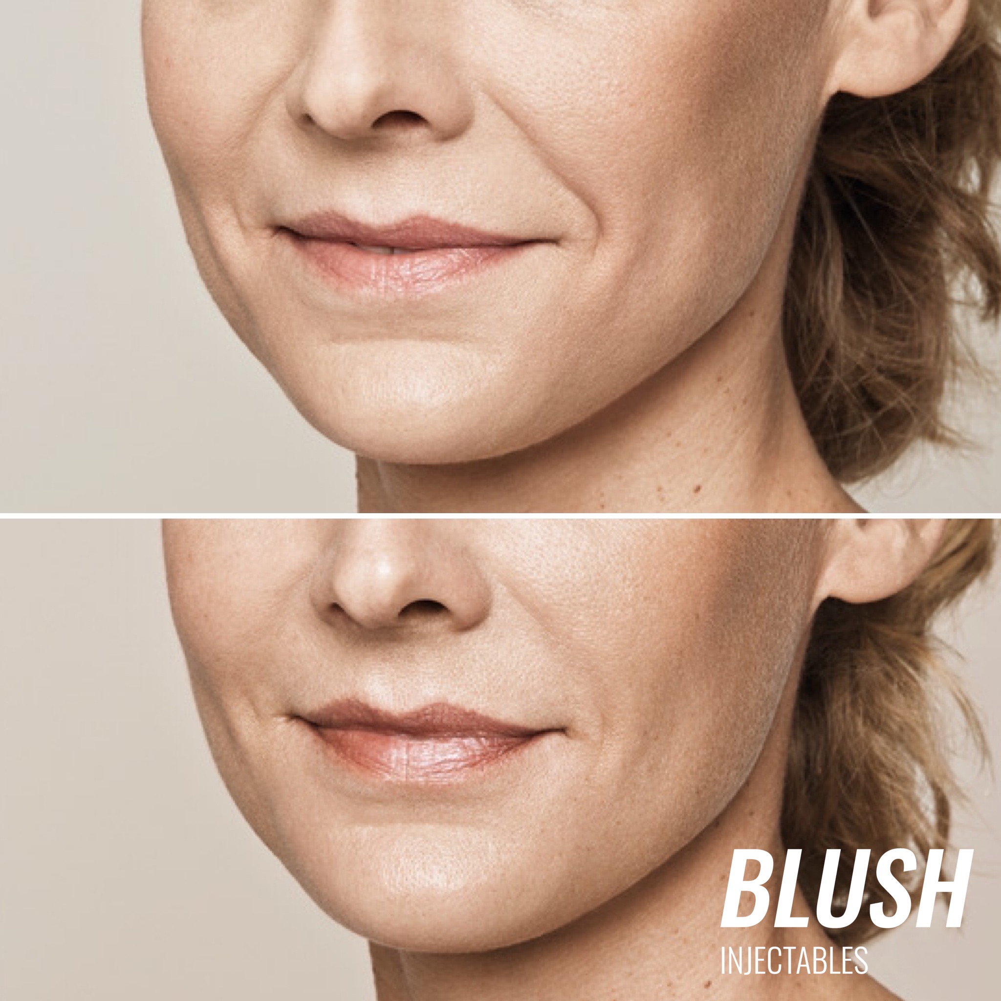 Voor en na filler behandeling | Blush botox en fillers in Best