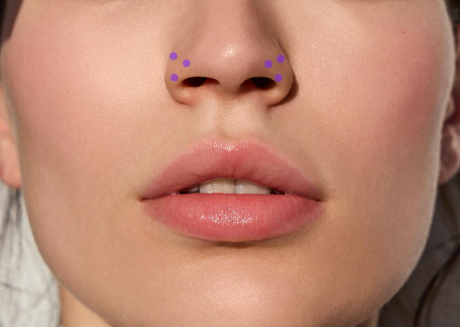 Botox neus: neusvleugels botox versmalt de neus